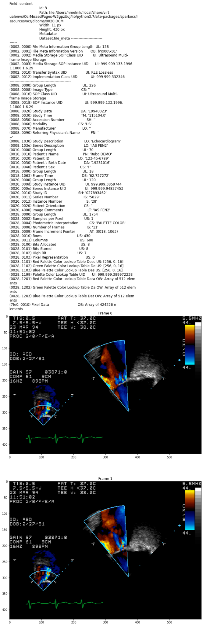 DICOM de-identification at scale in Visual NLP 2/3 - John Snow Labs